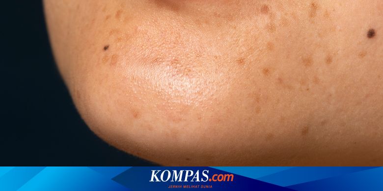 4 Jenis Flek Hitam di Kulit, Sunspots hingga Melasma