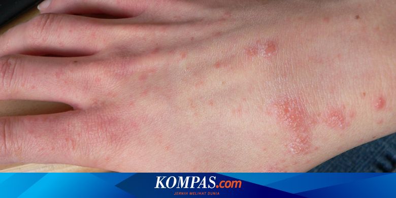 Bisa Menular, Ini Penyebab, Gejala, Pencegahan, dan Pengobatan Kudis