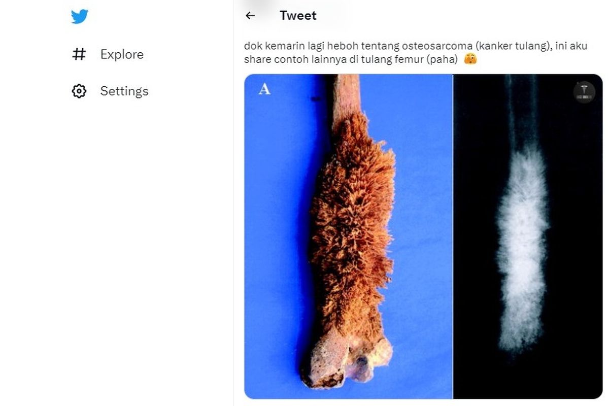 Ramai soal Kanker Tulang Disebabkan oleh Benturan, Benarkah? Ini ...