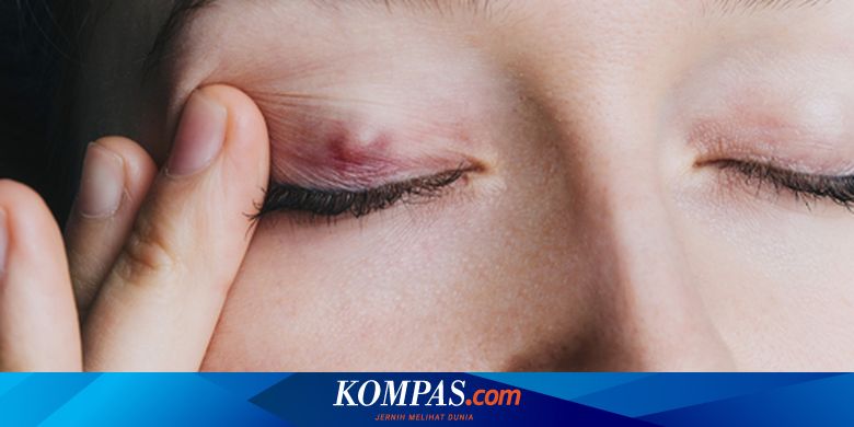 10 Penyebab Kalazion dan Cara Mengatasinya