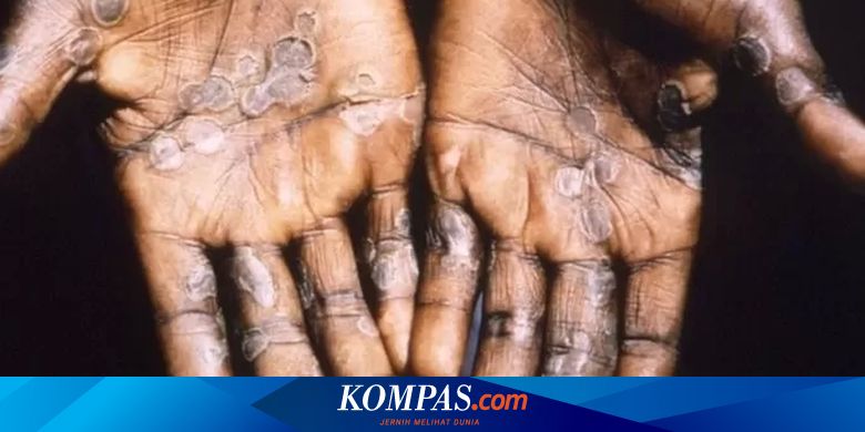 Ketahui Perbedaan Cacar Monyet dan Cacar Air Menurut Dokter - TrendRadars Indonesia