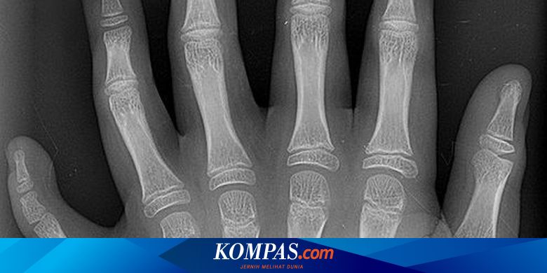 Punya 6 Jari Bukan Kelainan, Menurut Sains Ini Memberi Banyak Manfaat
