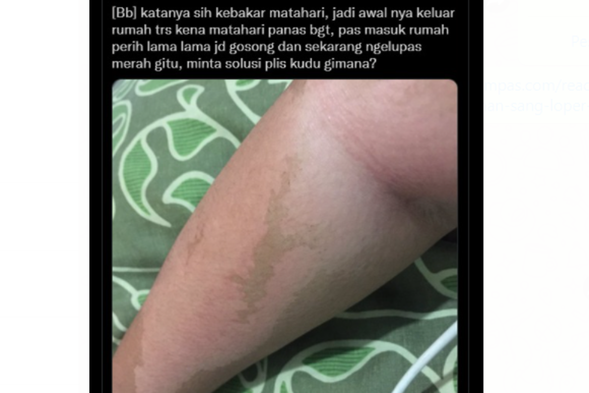 Kulit Mengelupas akibat Terbakar Sinar Matahari, Bagaimana Penanganannya?