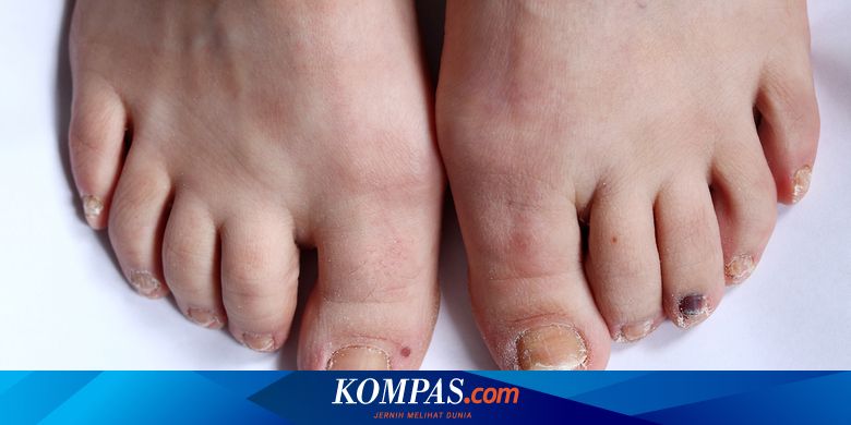 Penyakit Kuku Kaki Bergelombang - Gejala, Penyebab, Pengobatan - Kompas.com