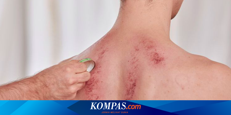 Manfaat dan Risiko Kerokan untuk Redakan Masuk Angin