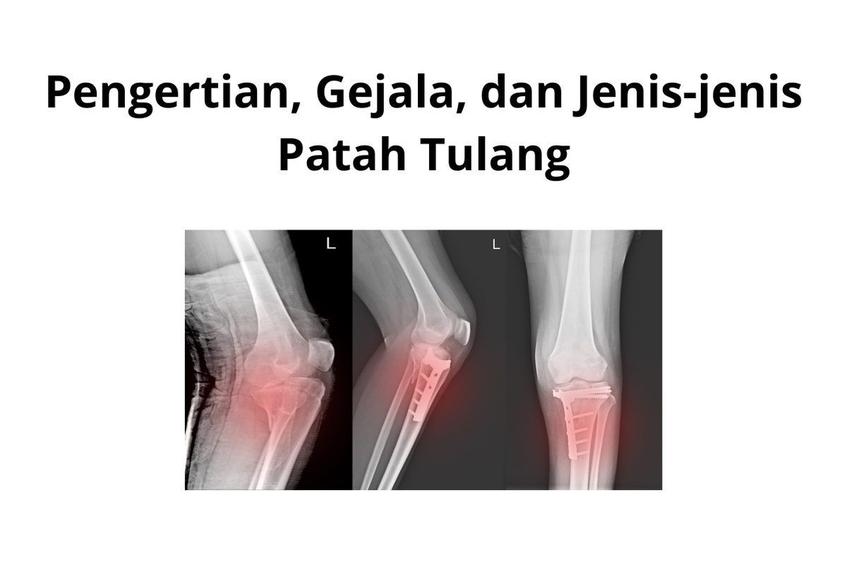 Pengertian, Gejala, dan Jenis-jenis Patah Tulang