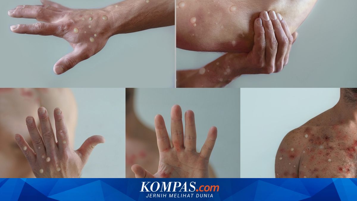 Bagaimana Ciri-ciri Ruam dari Gejala Monkeypox? Ini Ulasannya...