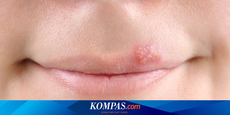 Penyakit Bibir Melepuh - Gejala, Penyebab, Pengobatan - Kompas.com