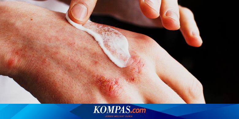 Eksim: Gejala, Penyebab, dan Penanganannya