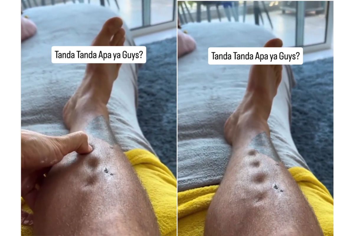 Cekungan di Kaki Tak Kembali Normal Usai Ditekan, Tanda Penyakit Apa?