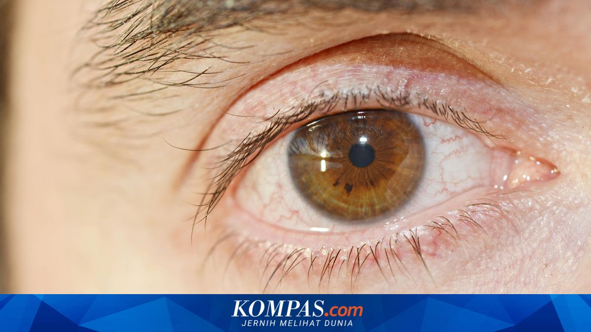 Makeup Mata yang Tak Dibersihkan Bisa Memicu Munculnya Tungau, Ini Tandanya