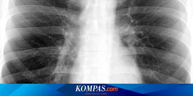 Anatomi Tulang Rusuk Manusia