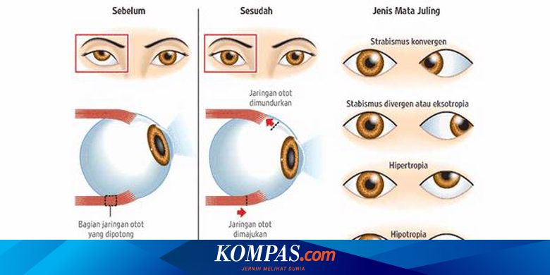 Strabismus Bisa Dikoreksi