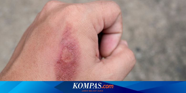 Berita Terkini Harian Tingkatan Luka Bakar Terbaru Hari Ini - Kompas.com