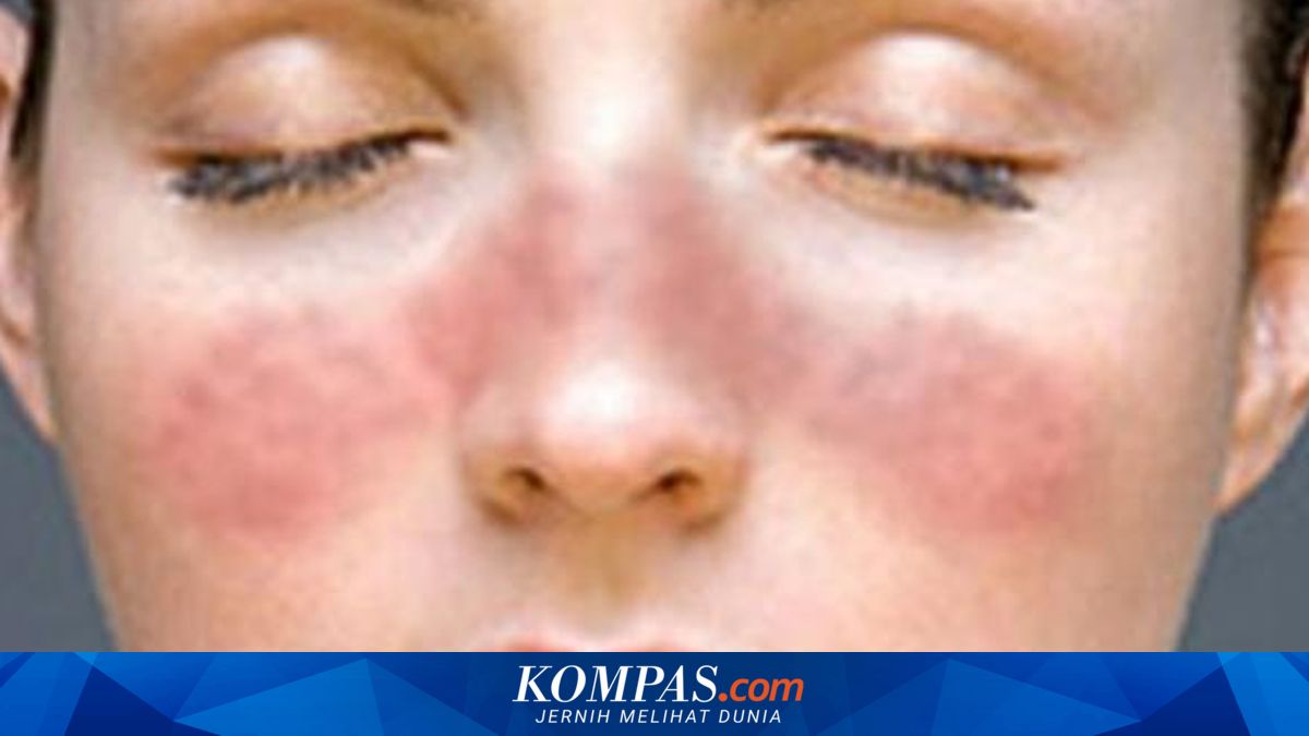 Penyakit Lupus: Penyebab, Gejala, dan Komplikasi