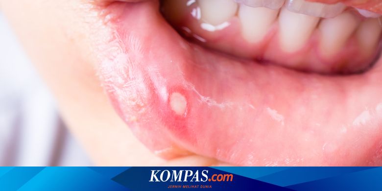 Berita Harian Ciri-ciri-kanker-mulut Terbaru Hari Ini - Kompas.com