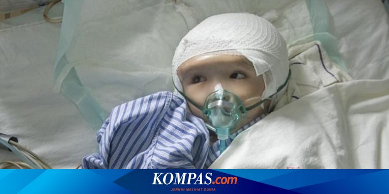 Pertama di Dunia, Operasi Rekonstruksi Kepala dengan Teknologi 3D