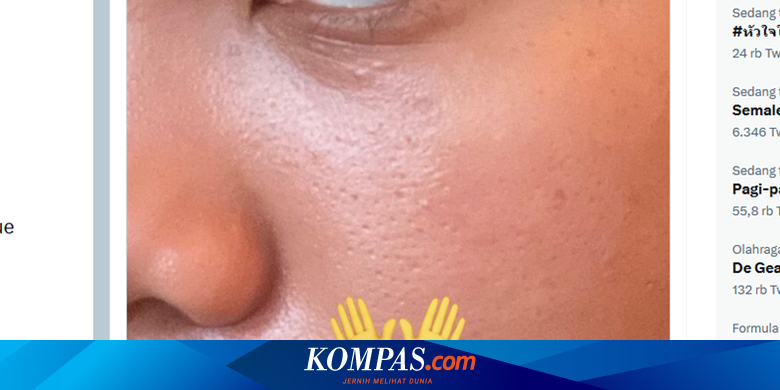 Ramai soal Kulit Wajah Terlihat Berlubang, Apa Penyebabnya?