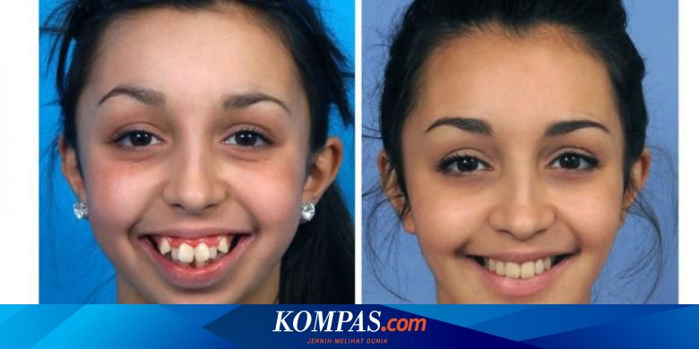 Usai Operasi Rahang, Wanita Ini Semakin Cantik dan Percaya Diri