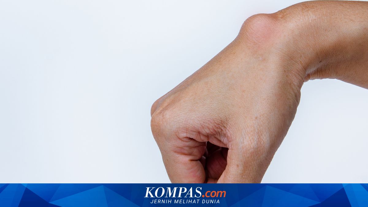 3 Cara Menyembuhkan Kista Ganglion, Tak Selalu Perlu Operasi