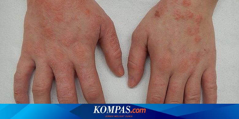 Muncul Gejala Eksim pada Anak, Lakukan 5 Hal Ini