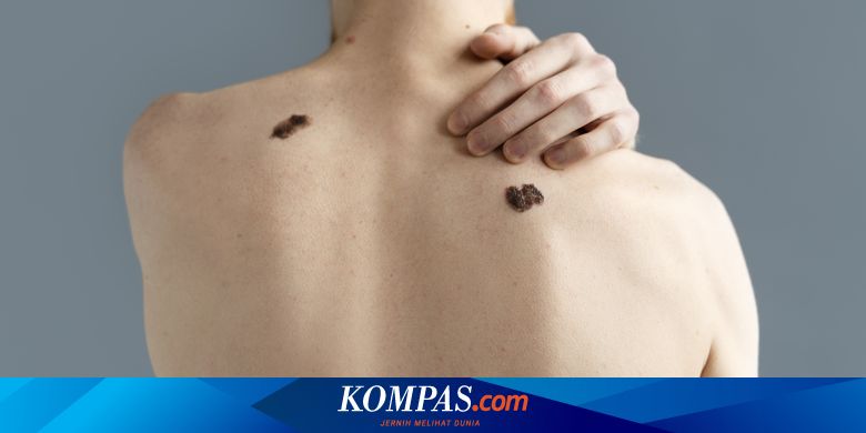 Fakta tentang Tahi Lalat yang Perlu Kamu Tahu