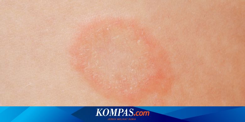 Kurap: Gejala, Penyebab, dan Penanganannya