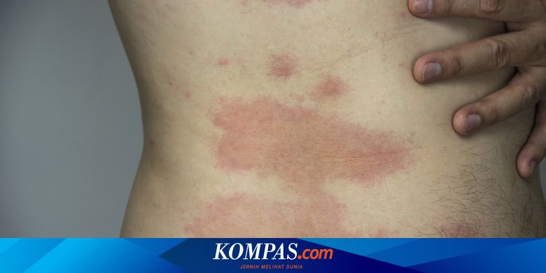 Liputan Khusus Mengobati Biduran