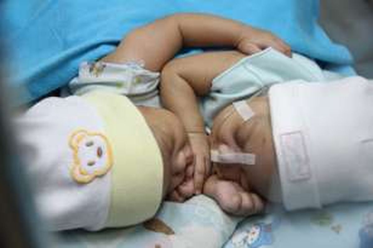 Bayi Kembar Siam Dempet Dada Miliki Kelainan Jantung