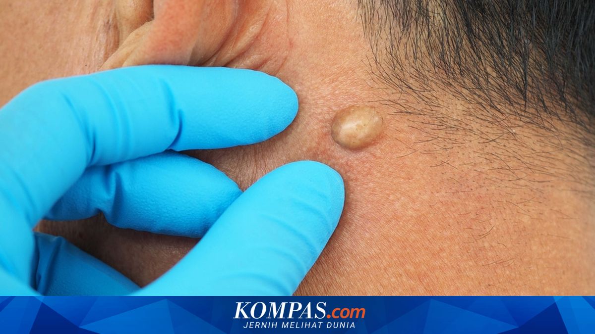 Mengenal Apa Itu Kista, Penyebab, dan Cara Menyembuhkannya