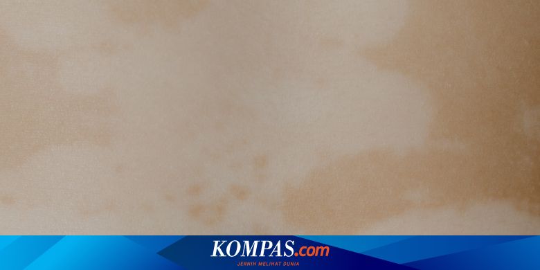 Mengenal Panu, dari Gejala hingga Cara Mencegahnya
