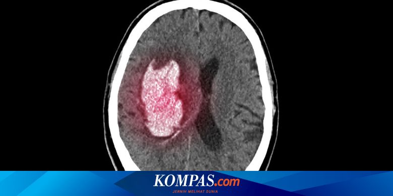 Penyakit Pendarahan Otak - Gejala, Penyebab, Pengobatan - Kompas.com