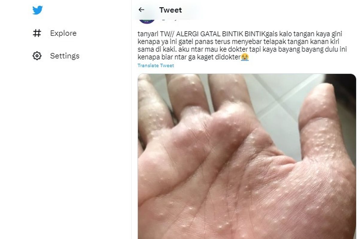 Ramai soal Bintik-bintik di Telapak Tangan yang Terasa Gatal dan Panas, Penyakit Apa Itu?