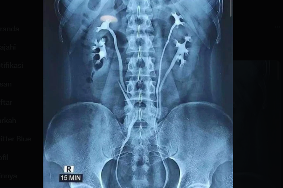 Satu Tubuh Punya Empat Ginjal, Bagaimana Bisa?