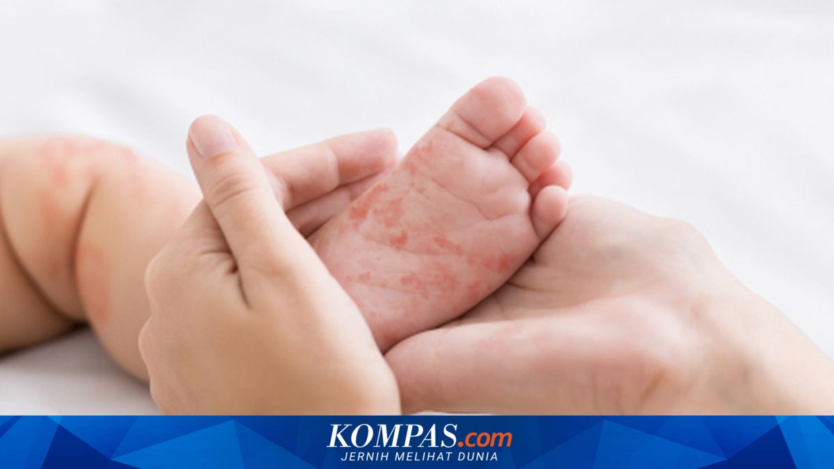 Bagaimana Penularan Campak Terjadi