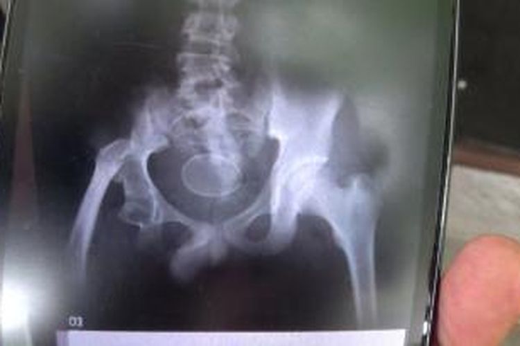 Hasil Rontgen Tunjukkan Benar-benar Ada "Telur" di Tubuh Akmal