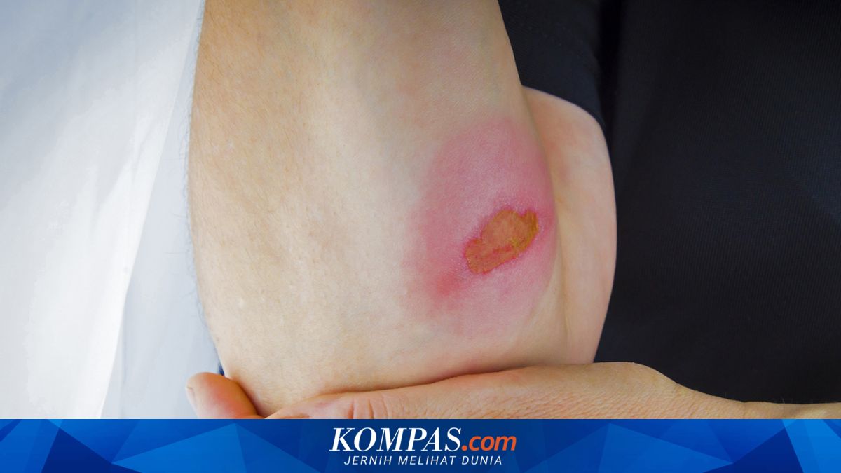 Keropeng Bisa Hambat Penyembuhan Luka, Ini Kata Dokter