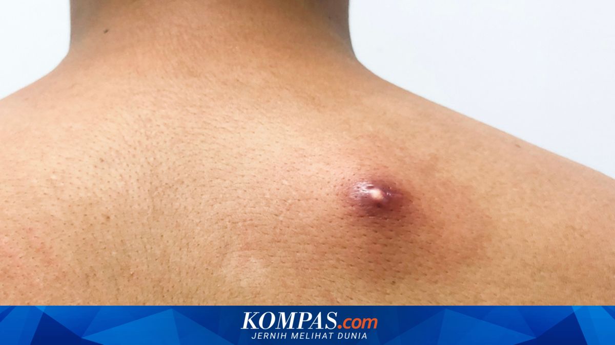 Gejala, Penyebab, dan Cara Mengobati Bisul