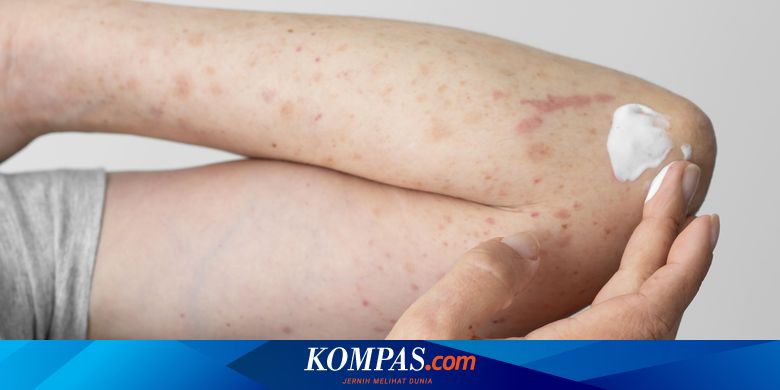 4 Bahan Skincare yang Bisa Meredakan Gejala Eksim