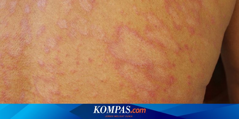 Penyakit Tinea Corporis - Gejala, Penyebab, Pengobatan - Kompas.com
