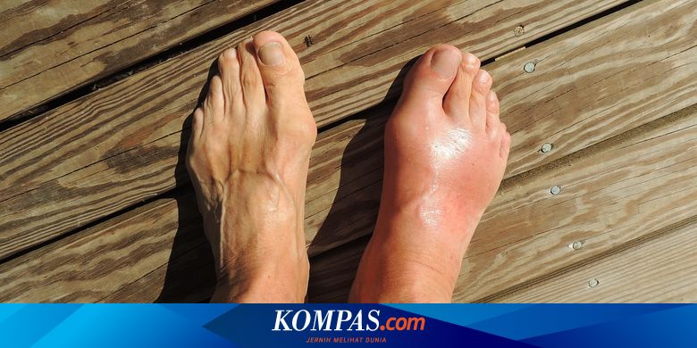 Apa Ciri-ciri Asam Urat di Kaki? Kenali 6 Gejalanya Berikut...