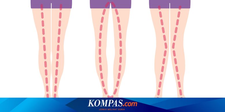 Penyakit Kaki Berbentuk X atau O - Gejala, Penyebab, Pengobatan ...