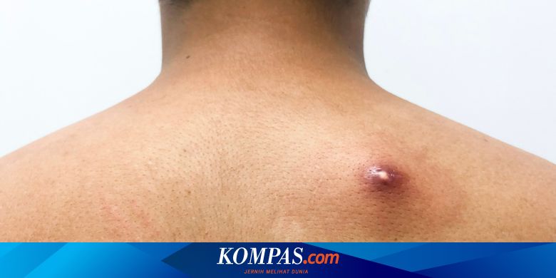 Jangan Sepelekan Bisul, Kenali Penyebab dan Cara Mengatasinya