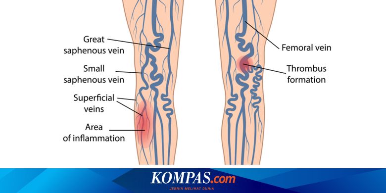 Penyakit Tromboflebitis - Gejala, Penyebab, Pengobatan - Kompas.com