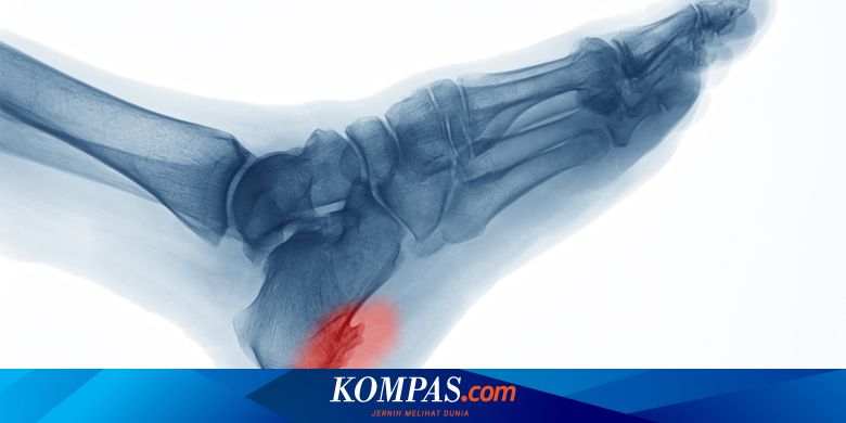 Penyakit Osteofit - Gejala, Penyebab, Pengobatan - Kompas.com