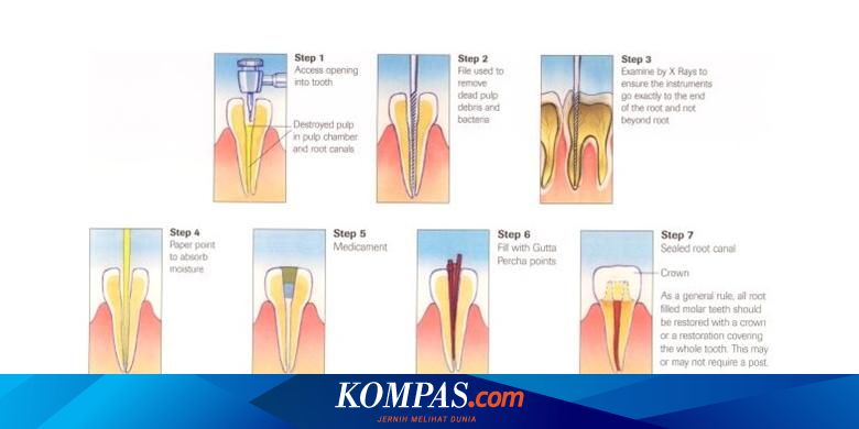 Proses Perawatan Gigi Berlubang