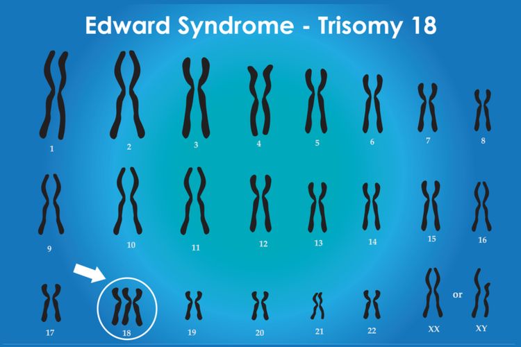 Foto : Sindrom Edwards (Trisomi 18)