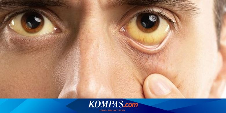 Penyebab dan Cara Mengatasi Mata Berwarna Kuning