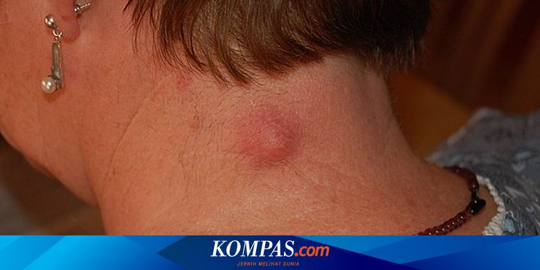 Mengenal Apa Itu Kista Epidermoid, Penyebab, dan Gejalanya