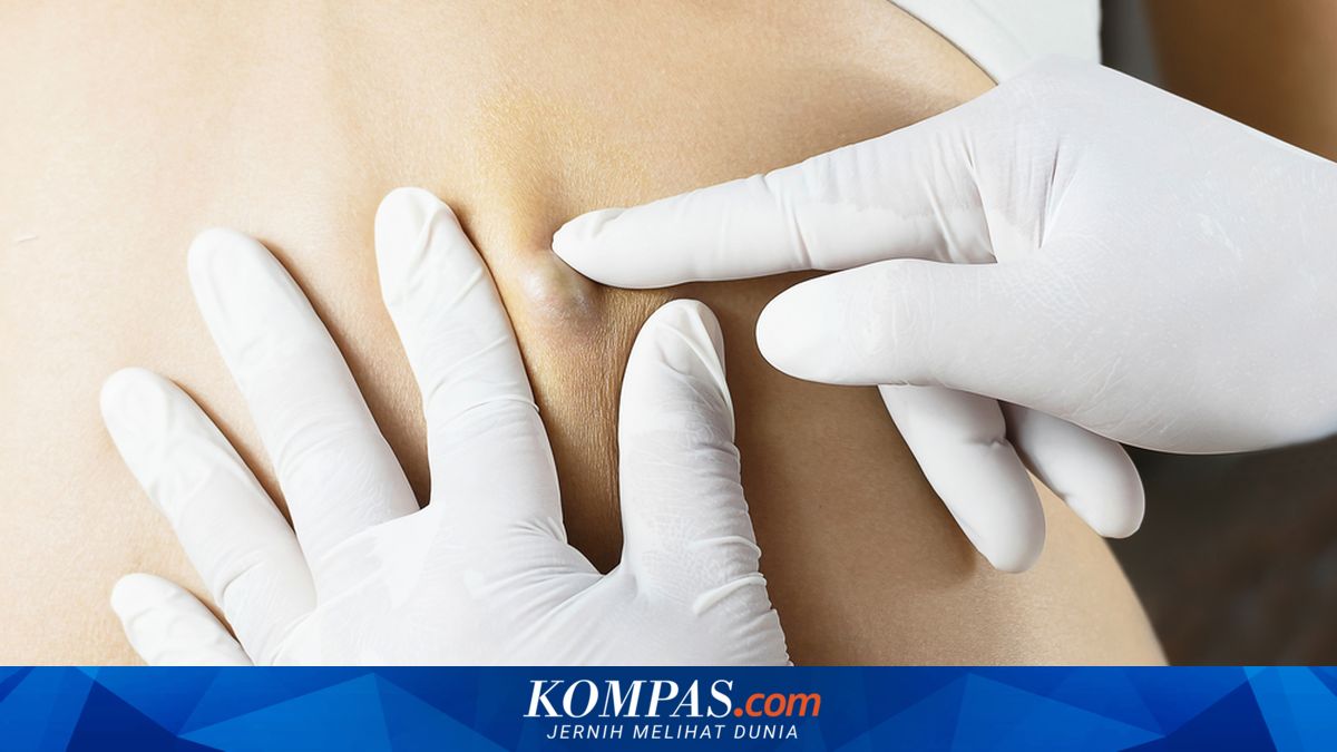 Kenali, Berbagai Jenis Kista dan Gejalanya